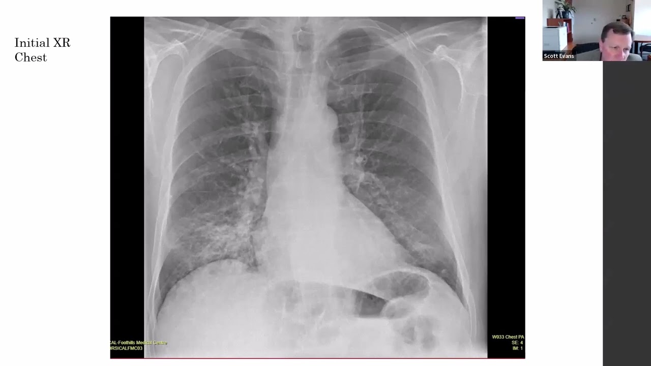 Community Acquired Pneumonia : Why is my patient not responding?