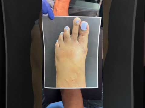 ULTRA TOE SHORTENING SURGERY👠#shorts
