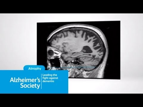 What is posterior cortical atrophy?
