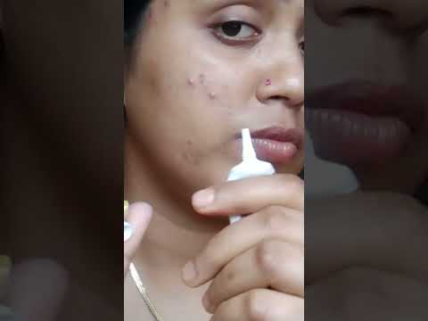 Best gel for pimple #medicinereview #pimplesremoval #acne #acnetreatment #Derivacmsgel#acnejourney
