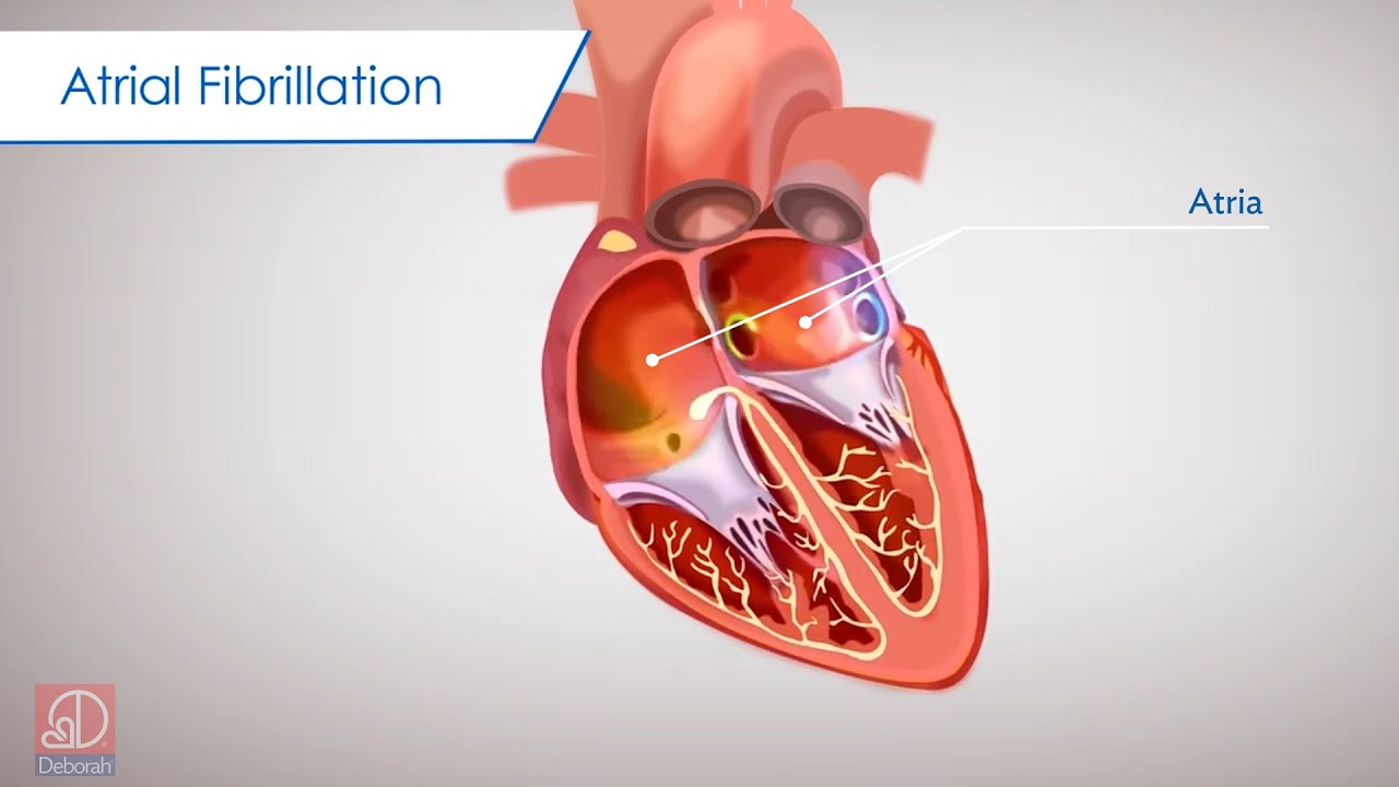 Atrial Fibrillation Animation