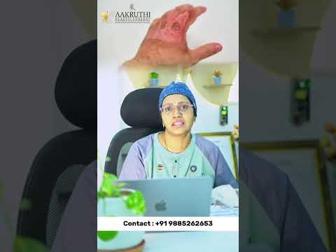 🔥✨ Regain Your Confidence After Burn Injuries: Expert Burns Treatment by Dr. Sireesha Rajesh