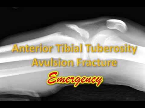 Anterior Tibial Tuberosity Avulsion Fracture Emergency