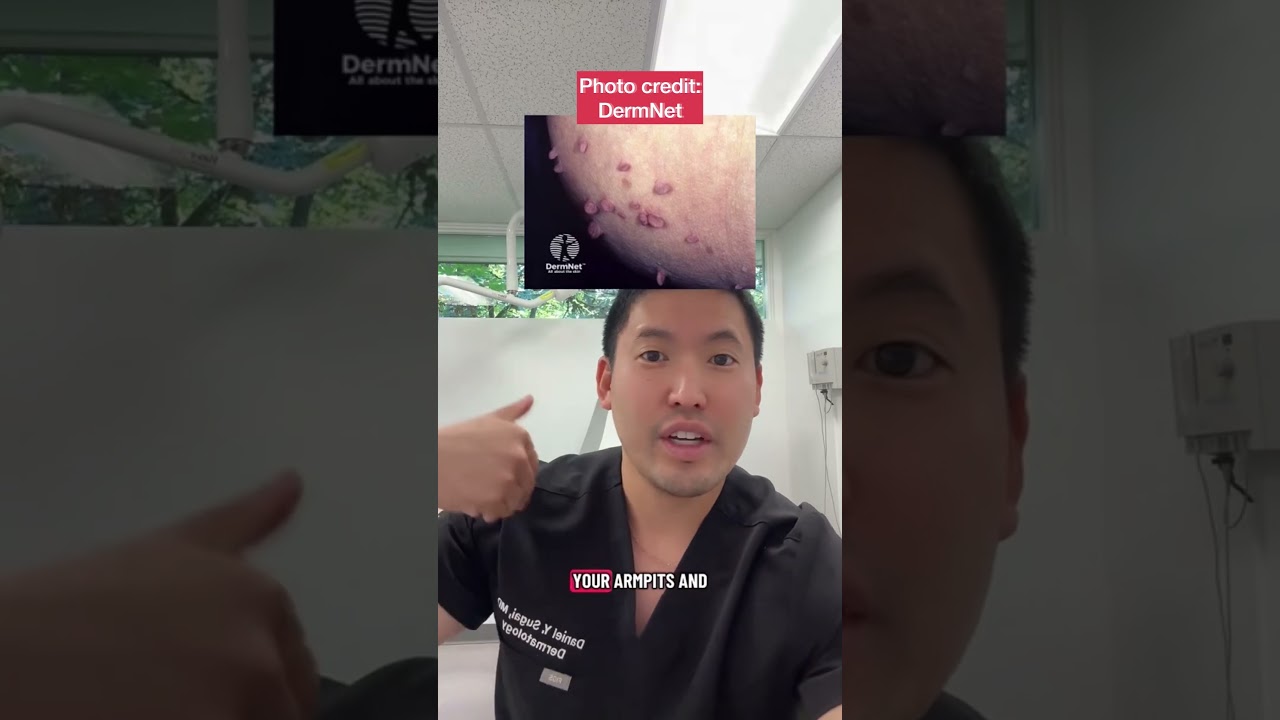 Do Dermatologists Recommend DIY Skin Tag Removal?
