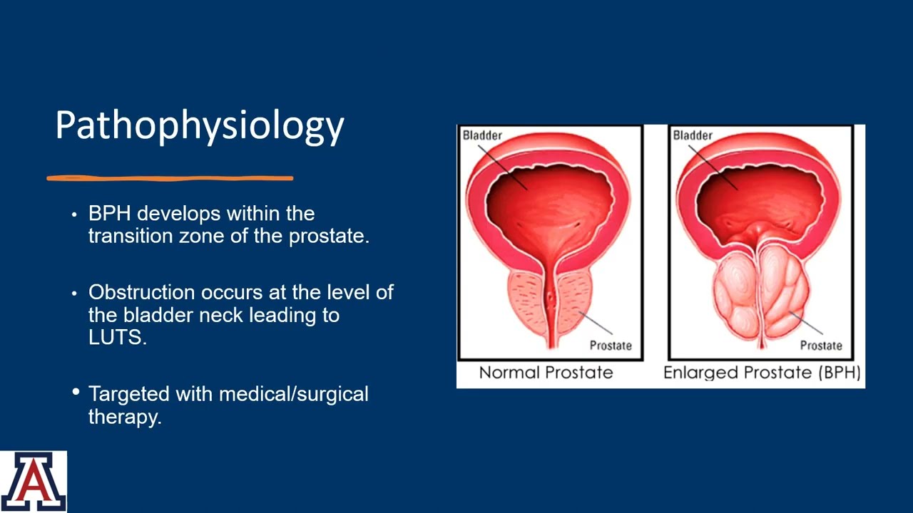 Benign Prostatic Hyperplasia: Post-Treatment MRI Findings