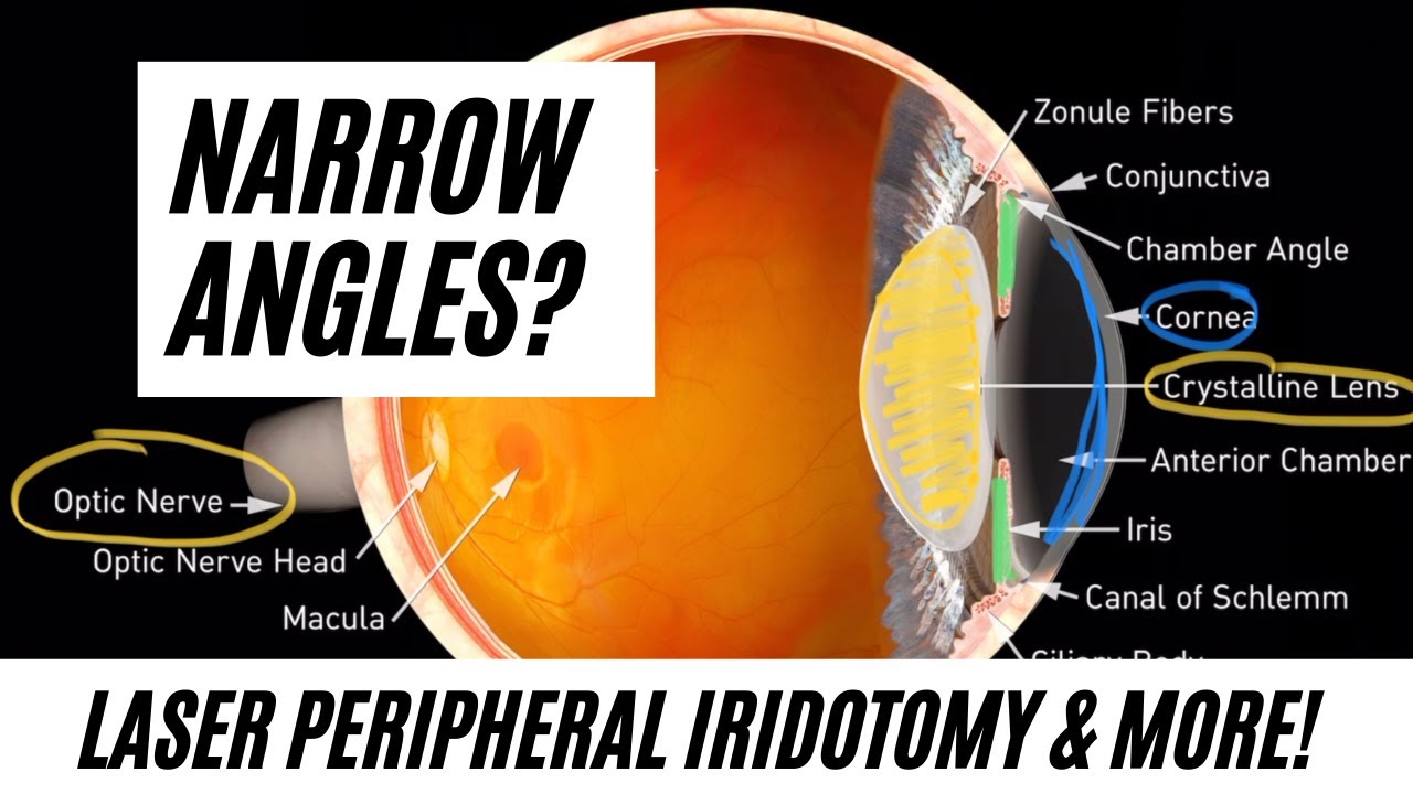 Narrow Angles? Does a Laser Peripheral Iridotomy LPI Work?