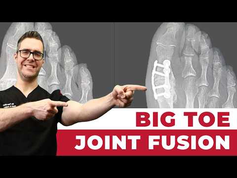 Top 10 Facts About First MTPJ Fusion Surgery | Recovery