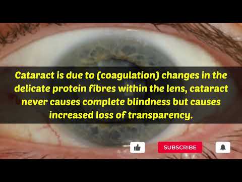 What is Cataract in eyes | Dense Nuclear Cataract | Peripheral Cataract