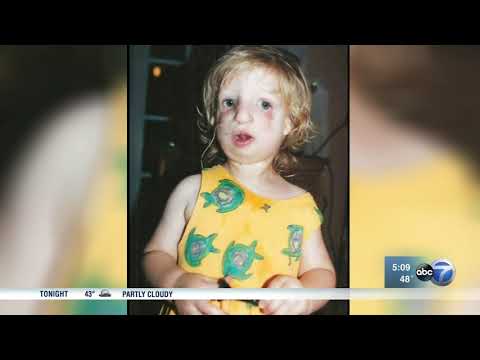 ABC7 Chicago - Teen talks about having Treacher Collins Syndrome, as seen in movie Wonder