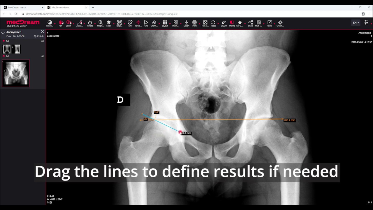 MedDream DICOM Viewer: show angles tool