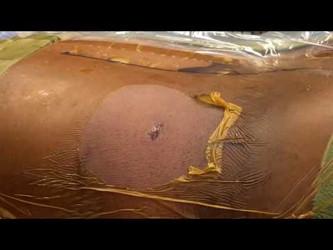 Retired physician with multilevel DDD and neuroforaminal stenosis