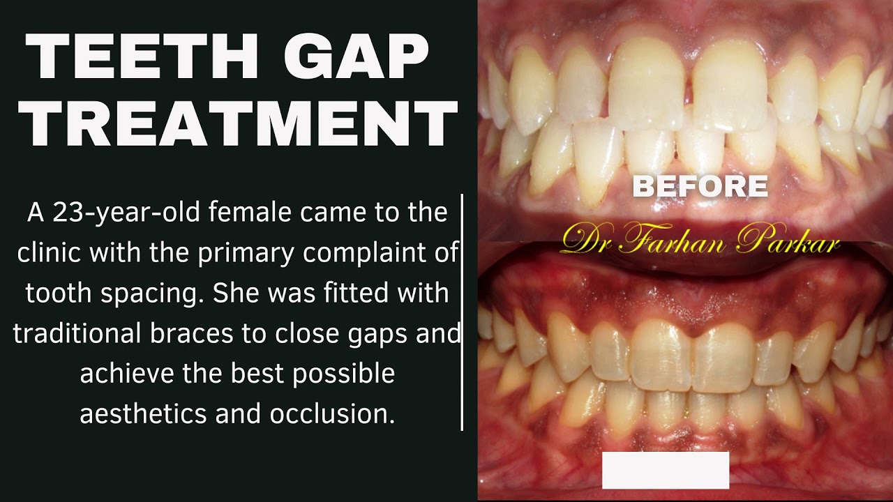 Closing Teeth Gap Dental Treatment in Bandra,Mumbai at Bliss Dental Clinic #shorts