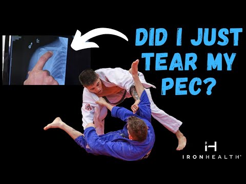 How do I know if I tore my pec? | Physical Therapy