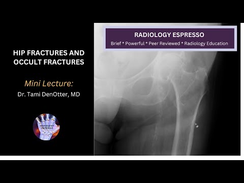 FRACTURES OF THE PROXIMAL FEMUR AND IMAGING OF ACUTE HIP PAIN: Mini Lecture, Dr. Tami DenOtter, MD