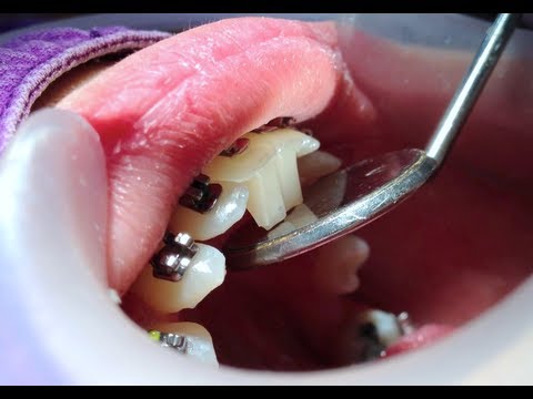 Orthodontics - Dental Braces with Bite Turbos Video Lecture