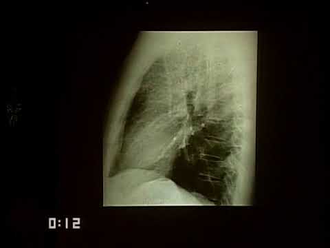 chest radiology lecture 2