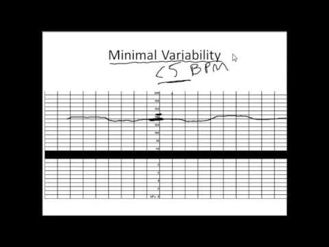 NonStress Test Made Simple
