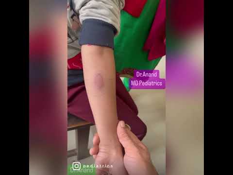 Mantoux Test | is this test positive? #shorts