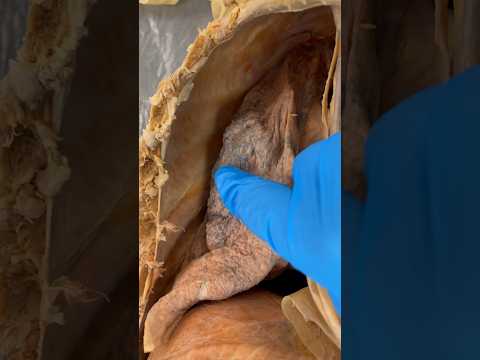 Important Tissue That Surrounds the Lungs