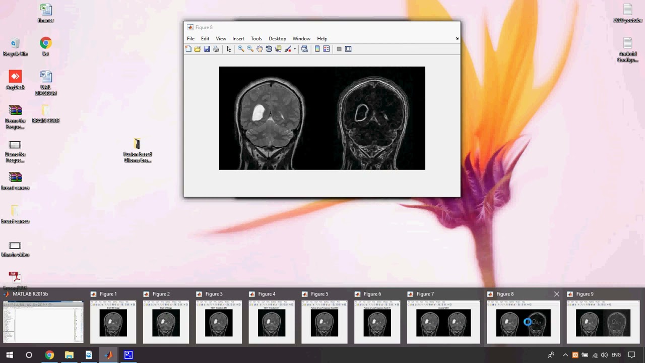 Fusion Based Glioma Brain Tumor Detection In Matlab Okok Projects Final Year Projects