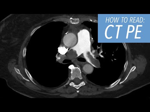 How to Read a CTA of the Chest Pulmonary Embolism Protocol