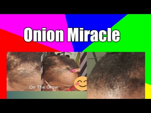 My ONION OIL APPLICATION on 4c Fine Hair (Alopecia Defense)