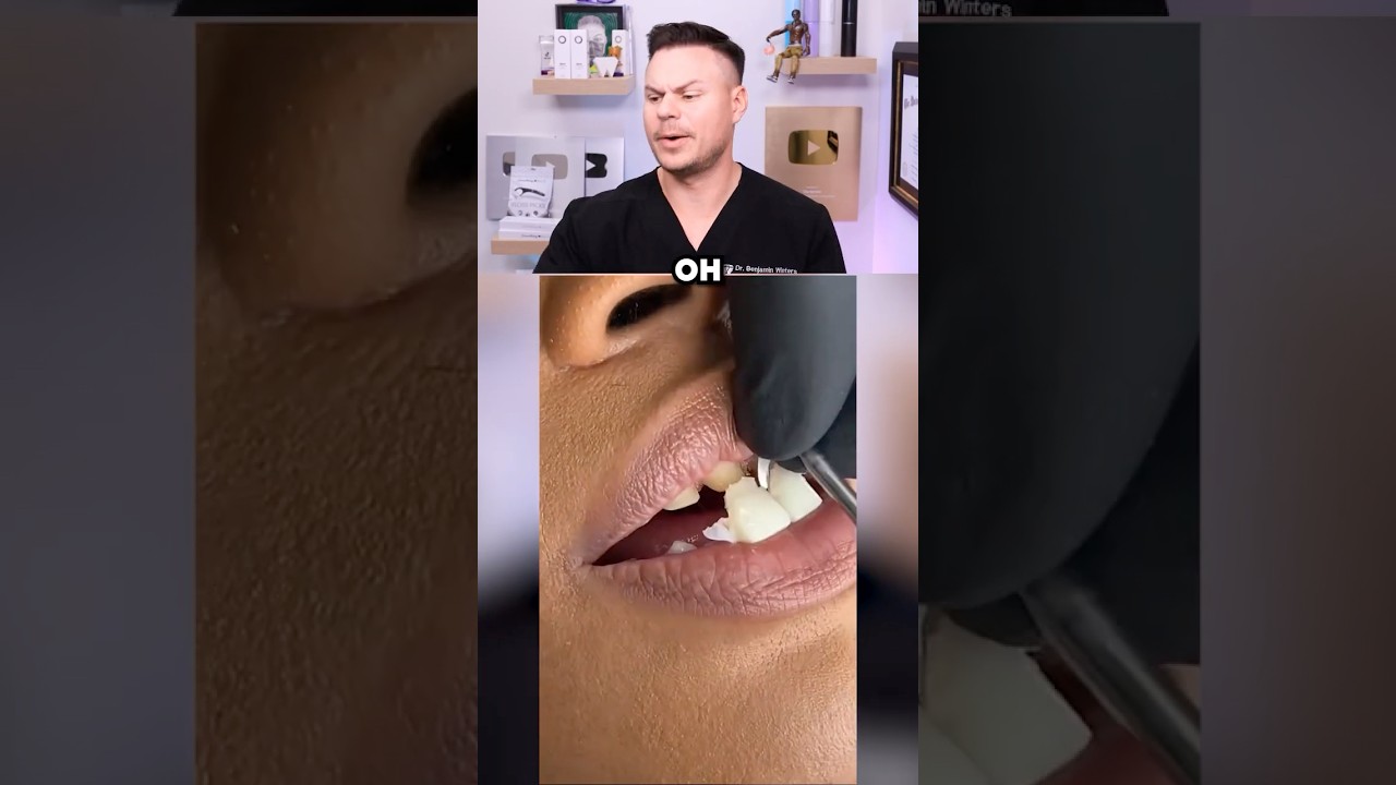 This Before And After Veneers Looks AMAZING!