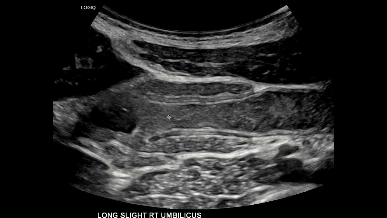Small bowel intussusception on ultrasound