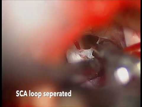 Trigeminal neuralgia MVD: AICA and SCA dual compression
