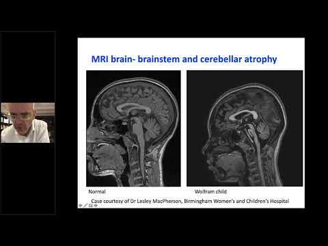 Wolfram syndrome