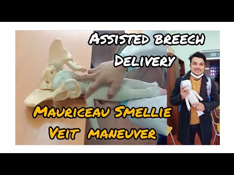 Mauriceau Smellie veit maneuver,Assisted breech delivery | aquiqur rahman #college #mbbs #mbbsabroad