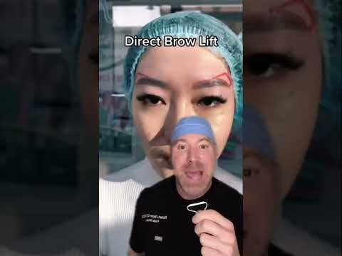 Direct Brow Lift or Botched Brow Lift? 😱 #shorts