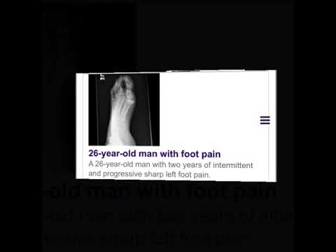 Periosteal (juxtacortical) chondroma