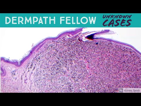 Dermpath Fellow Unknown Cases! Filler reaction, large B-cell lymphoma, radiation dermatitis, & more