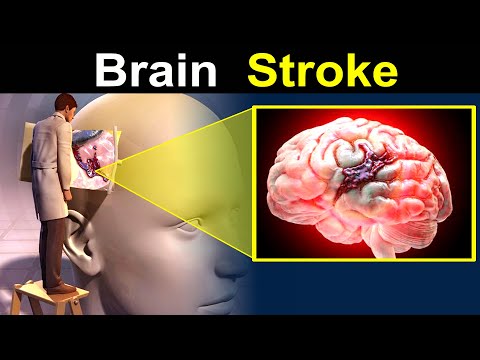 Brain Stroke || Hemorrhagic And Ischemic Stroke || Causes and Treatment || Urdu/Hindi ||