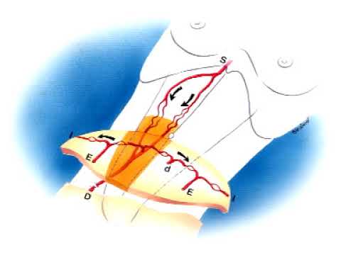 Contralateral pedicle TRAM flap
