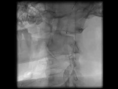 Critical stenosis of the left internal carotid artery Ass professor Vasilevsky V P