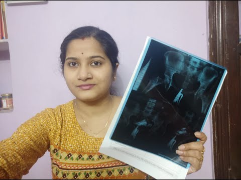 #mypregnancyjourney part 2 II what is HSG II Why HSG test done II My experience In Bengali.