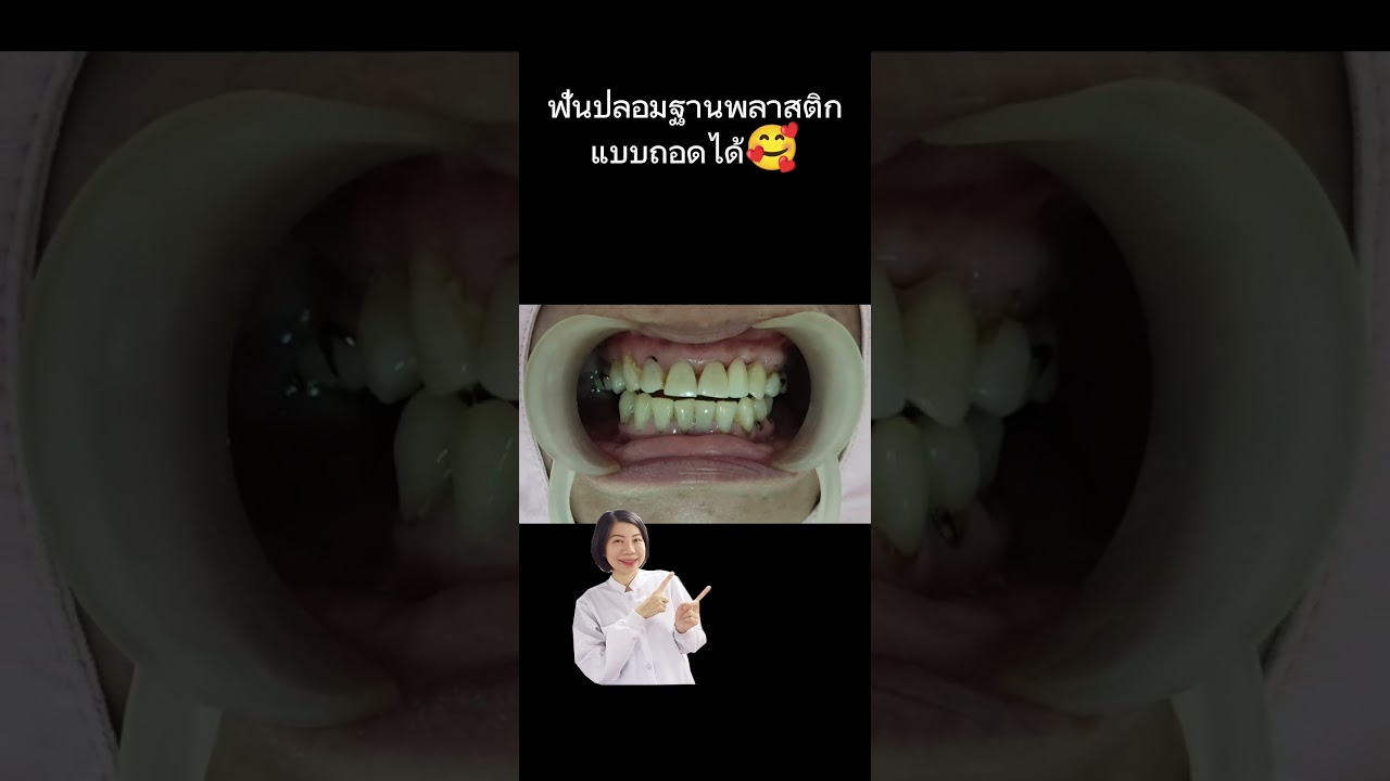 ฟันปลอมฐานพลาสติกแบบถอดได้