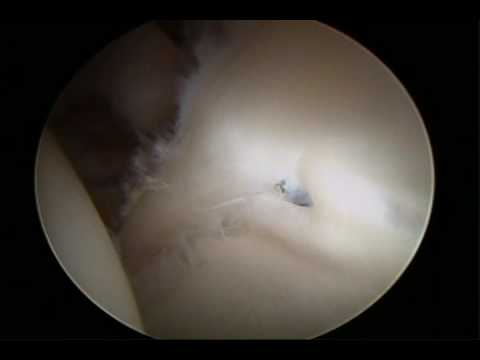 Hip Arthroscopy: Labral Detachment for Acetabular Rim Trimming