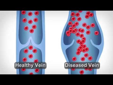 Varicose Vein Treatment with the Venefit™ Procedure