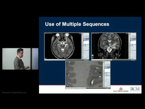 Hypothalamic Hamartoma: The Prospect of Laser Ablation Surgery by Daniel Curry