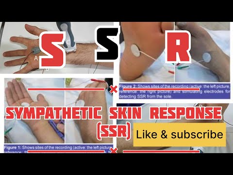 SSR (sympathatic skin responce) | galvanic response #neurotech #NCS #emg