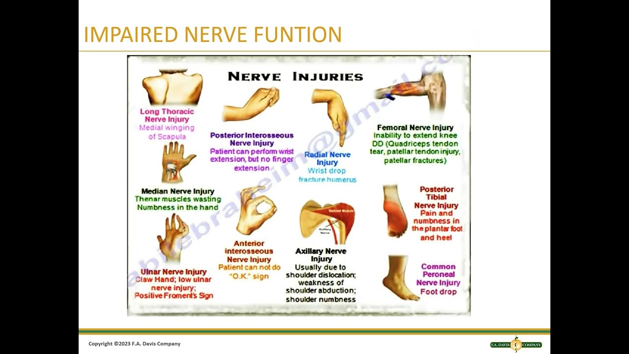 Chp 13: Peripheral Nerve Injury Management