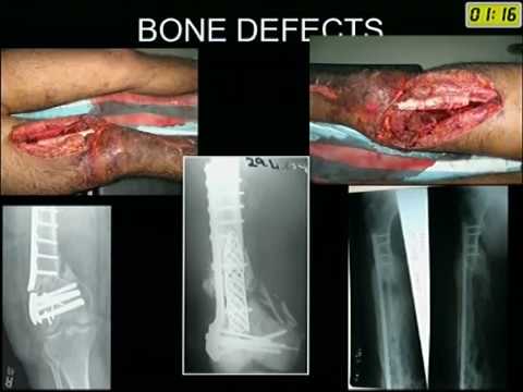 Distal Femur Fractures