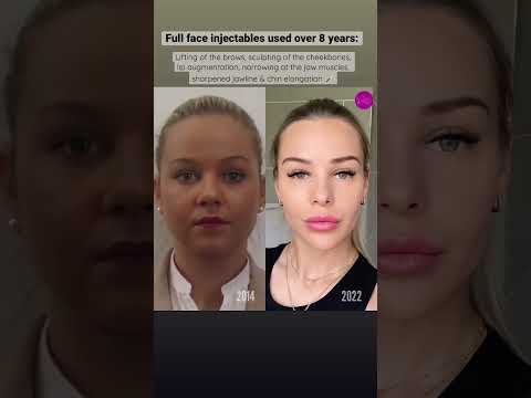 DERMAL FILLERS OVER 8 YEARS! | BEFORE & AFTERđź’‰ #dermalfillers #youtubeshorts #shorts #fillers
