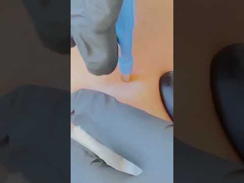 SHORT: ARM DERMATOFIBROMA!