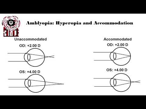 Ocular Disease and Refractive Error Spotlight Amblyopia