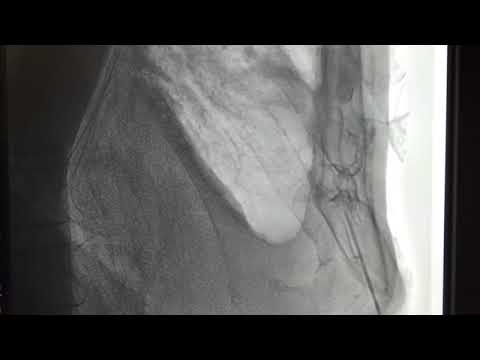 Pericardiocentesis