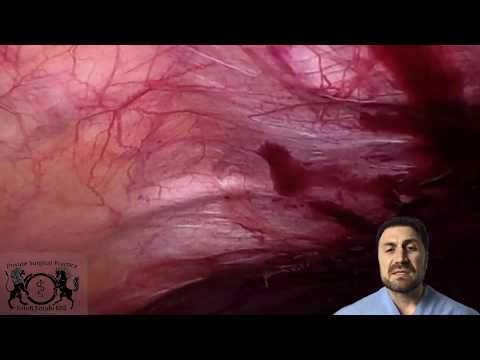 Laparoscopic Lysis of adhesions-Scar tissue removal